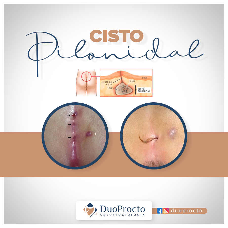 Tudo Que Voc Precisa Saber Sobre Cisto Pilonidal Primazo